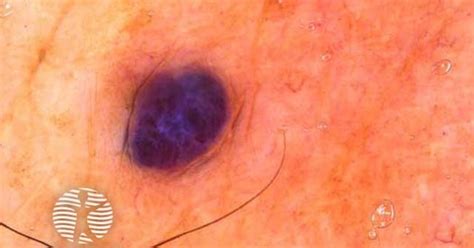 Dermnet® Dermoscopy Image