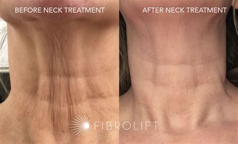 Schb How Does Plasma Fibroblast Work