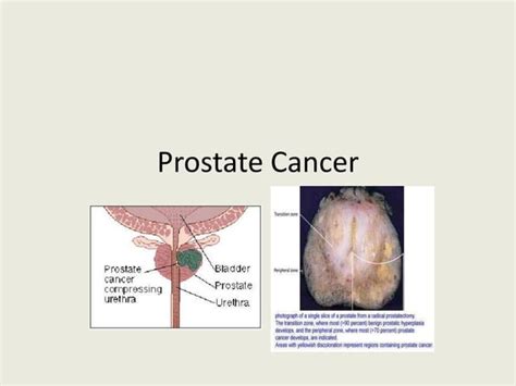 Male Reproductive System Disorders And Diseases Pptx