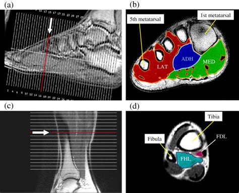 Foot Muscles Mri Mri Scan London Sports Orthopaedics Hip Pelvis