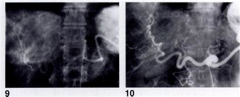 62 Year Old Woman With Peripheral Cholangiocarcinoma Celiac Angiogram
