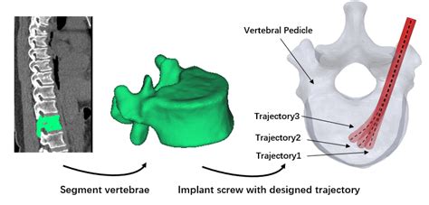 Procedure Of Building Up An Fe Model From Qct Scans Figure Also Shows