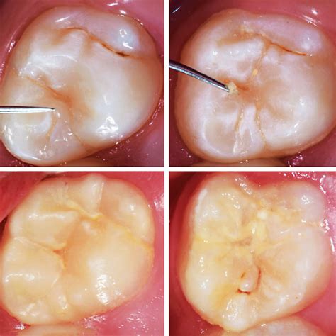 Pdf Occlusal Caries Biological Approach For Its Diagnosis And Management