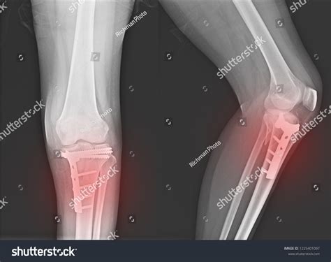 Proximal Tibia