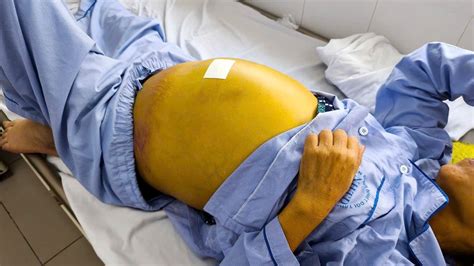 V Ng Da Nh Ngh Au Ch N I Kh M B T Ng Ph T Hi N Vi M Gan B Giai O N Cu I