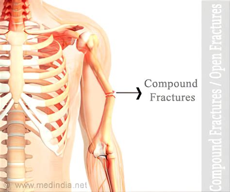 What Is A Compound Fracture Free Delivery Gbu