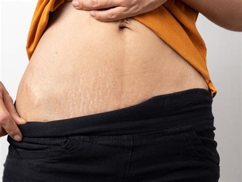 How To Deal With Stretch Marks Why They Appear Treatment Options
