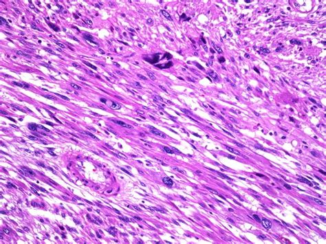 Leiomyosarcoma Of Uterus