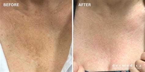 Pigmentation Unveiled Causes And Effective Treatment Options Explored