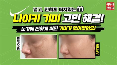 📢눈가에 퍼졌다 눈가 나이키 기미 치료사례🔍 Youtube