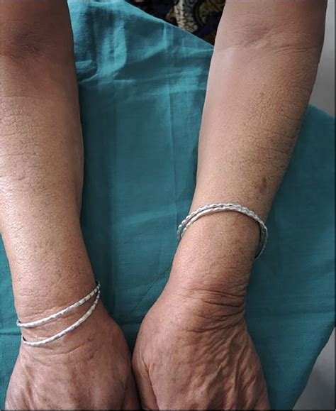 Hyperthyroidism Rash