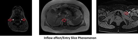 Flow Artifact Mri Csf Flow Artifact