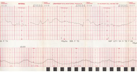 Intrapartum Fetal Assessment Obstetrics Medbullets Step 2 3