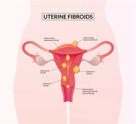 All You Need To Know About Fibroids Smg Womens Health