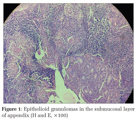 Isolated Tubercular Inflammation Of The Appendix A Case Report
