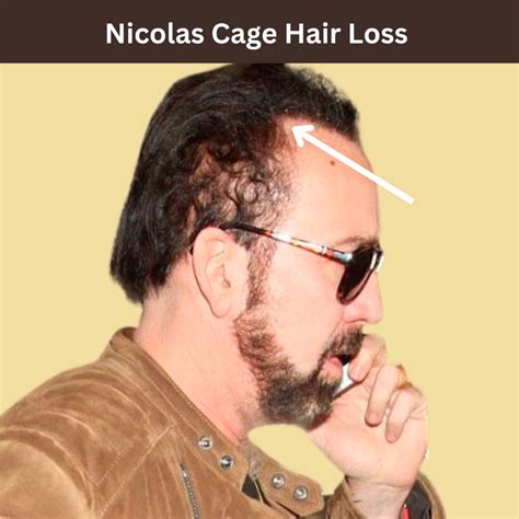 Nicolas Cage Hair Transplant Before And After Transformation