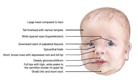 Faqs • Facial Features • Noonan Syndrome Association