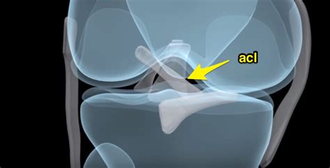 What Happens In ACL Reconstruction Surgery