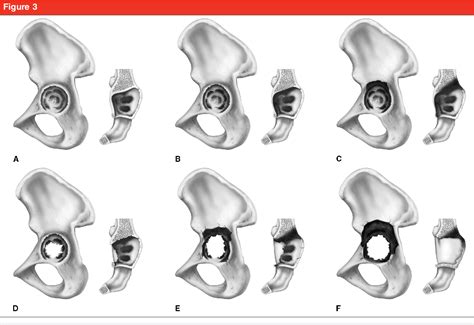 Figure 3 From Acetabular Bone Loss In Revision Total Hip Arthroplasty Evaluation And Management