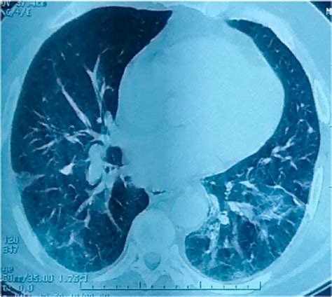 A Chest Ct Scan Was Performed Showing An Appearance Compatible With Download Scientific