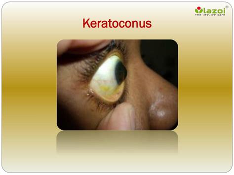 Ppt Keratoconus Causes Symptoms Daignosis Prevention And Treatment Powerpoint Presentation