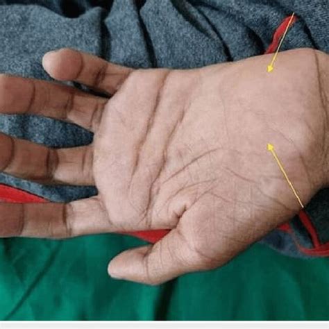 Atrophy Of Bilateral Lower Limb Muscles More Marked In The Calf Download Scientific Diagram