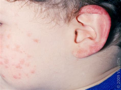 Infant Hives Face