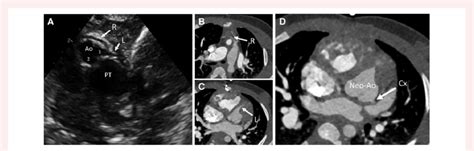 Coronary Artery Distribution Pattern In Our Patient A Postnatal