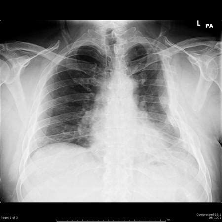 Flail Chest Management Astonishingceiyrs