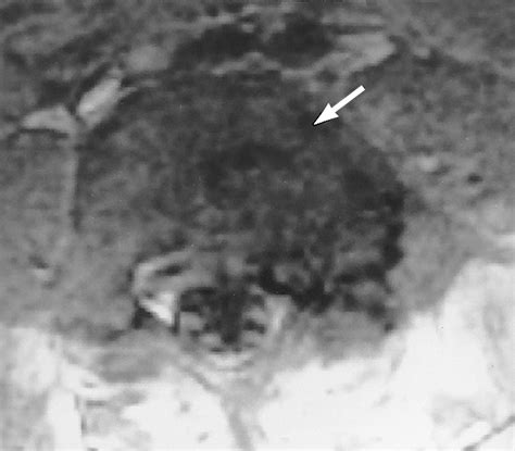 Hemangioma From Head To Toe Mr Imaging With Pathologic Correlation