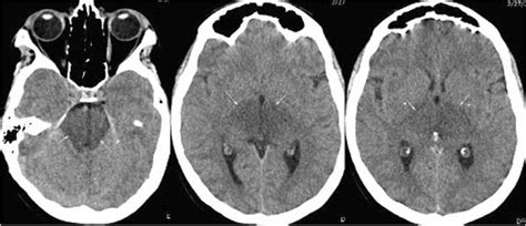 Initial Brain Ct Scan Hypodense Aspect Of The Upper Brainstem And