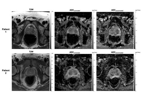 Distortion Correction Of A Clinical Standarddiffusion Weighted Prostate