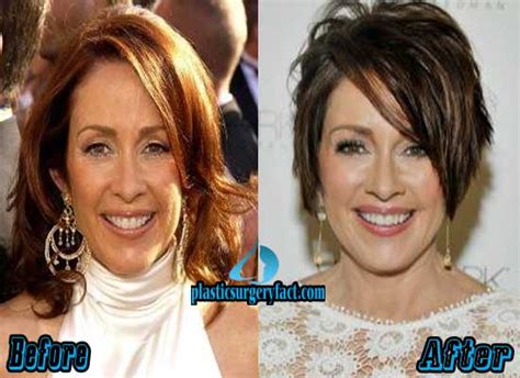 Patricia Heaton Before And After