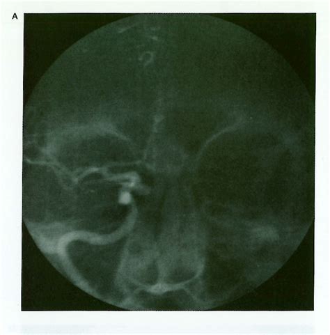 Figure 1 From Trattamento Daneurismi Cerebrali Con Interlocking