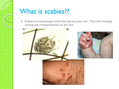 Ppt Scabies Powerpoint Presentation Free Download Id 2335103