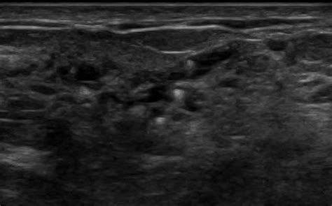 Breast And Axilla 52 Malignant Breast Lesions Case 5213