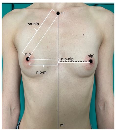 Breast Fluctuating Asymmetry In Women With Macromastia Gigantomastia