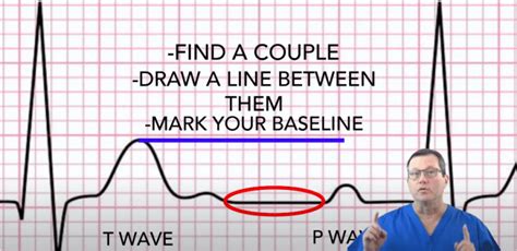 St Segment Elevation Explained 12 Lead Ecg Resources Acls