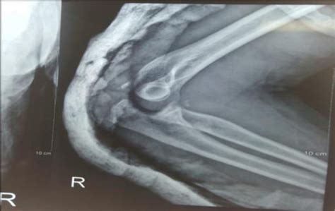 Right Elbow Lateral X Ray Download Scientific Diagram