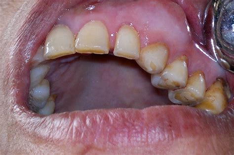 25 Facts About Hirsutism Congenital Gingival Hyperplasia