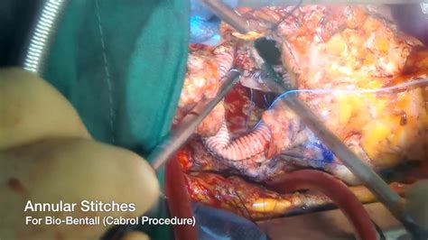 Redo Aortic Root Replacement Cabrol Procedure And Commando Operation For Extensive Prosthetic