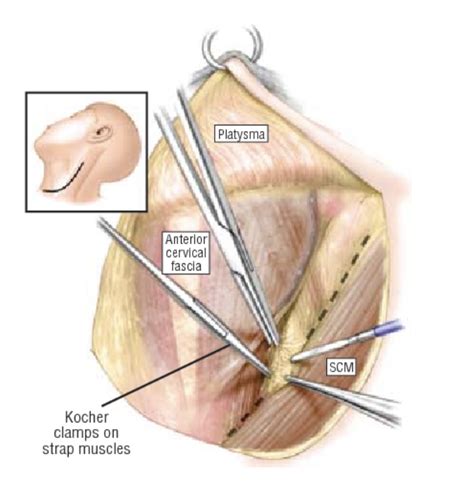 Modified Dissection Surgery Renda Clinic