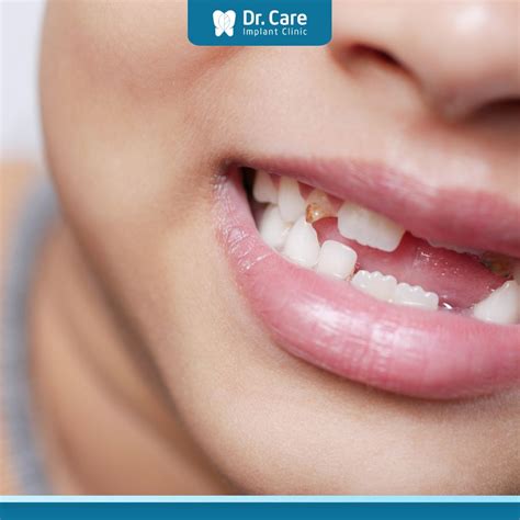 Sún Răng ở Trẻ Cần Làm Gì Mất Răng Sữa Do Sún Răng Gây ảnh Hưởng đến