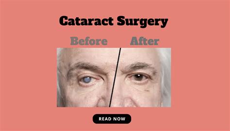 How Long Do Halos Last After Cataract Surgery Detroit Chinatown
