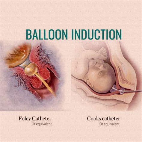 Pregnancy Balloon Induction A Natural Way To Start Labor 🎈🤰 Balloon