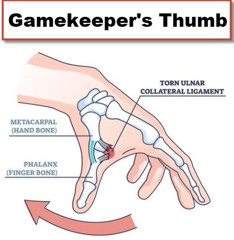 Gamekeepers Thumb Joi Jacksonville Orthopaedic Institute