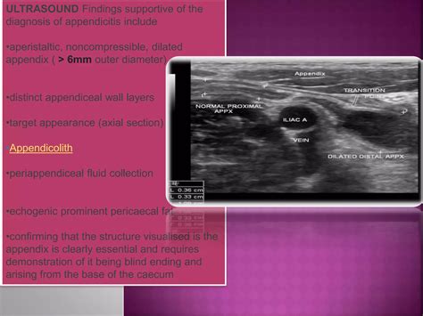 Acute Appendicitis Pptx Digestive Disorders Diseases And Conditions
