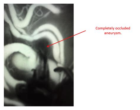 Brain Aneurysm Gold Coast Brain And Spine Surgeon Dr Lee Liqun Yang