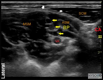 Ultrasound Guided Interscalene Brachial Plexus Block Nysora The New