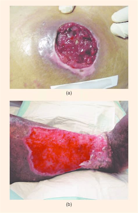 A Unhealthy And B Healthy Granulating Tissues Photos Courtesy Of